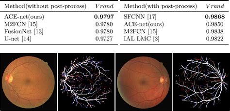 Ace Net Biomedical Image Segmentation With Augmented Contracting And