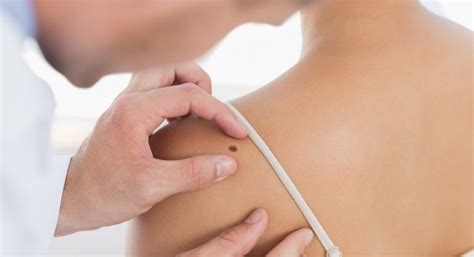 Guía Para Identificar Lunares Cancerígenos Tipo Melanoma Viva Mi Salud