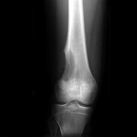 Osteosarcoma Codmans Triangle