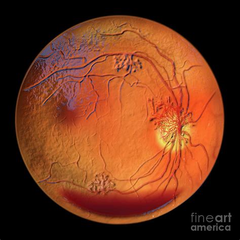 Retina Damage From Diabetes 133 By Science Photo Library