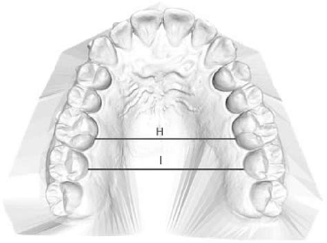Upper Maxillary Arch Widths Measured On T1 And T2 Models At The Groove
