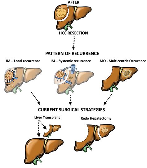 Surgical Strategies For Recurrent Hepatocellular Carcinoma After Resection A Review Of Current