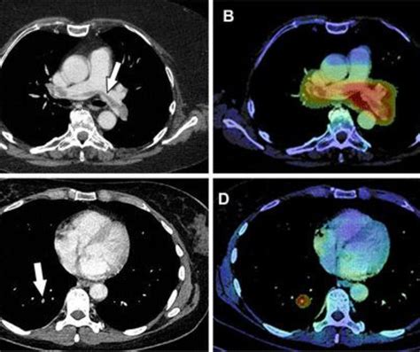 emerging ai tool improves worklist triage and ct detection of