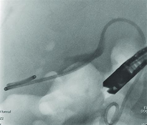 Deployment Of First Plastic Stent Download Scientific Diagram
