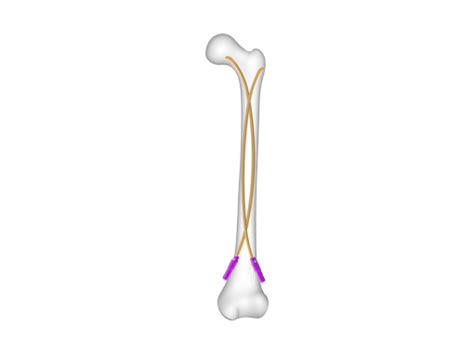 Titanium Elastic Nail Tens System Hip And Femur