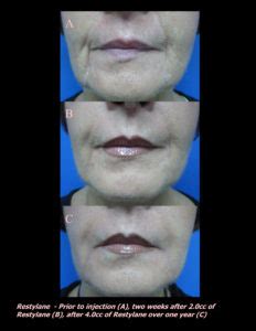 Why Does Hair Grow On My Ears Appalachian Spring Dermatology