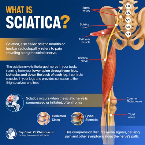 Sciatica Symptoms Causes And How To Relieve Sciatic Pain Naturally