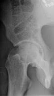 False Profile Hip Elements Of Radiography