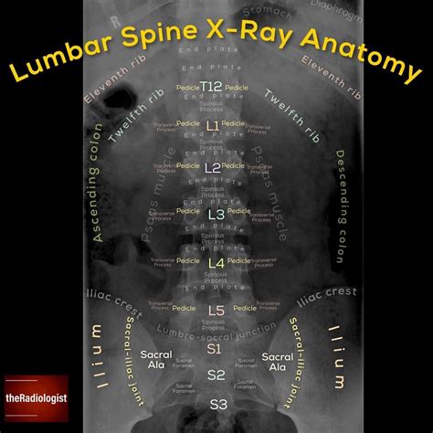 Lumbar Spine X Ray Labeled At Mary Langan Blog