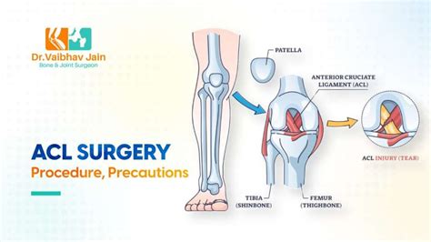 What Precautions Should Be Taken After Acl Surgery