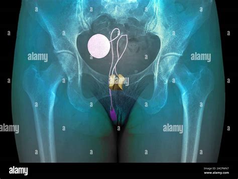 Artificial Urinary Sphincter Coloured X Ray Of The Pelvis Of A 55 Year