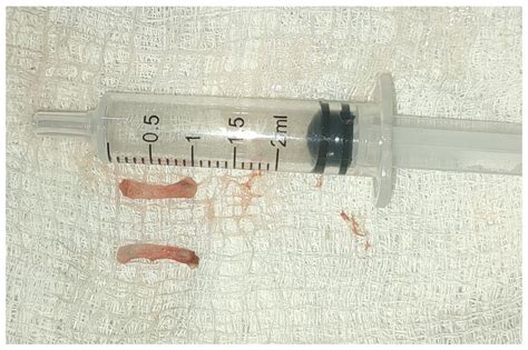 The Resected Specimen Of Styloid Processes In A Patient With Eagles