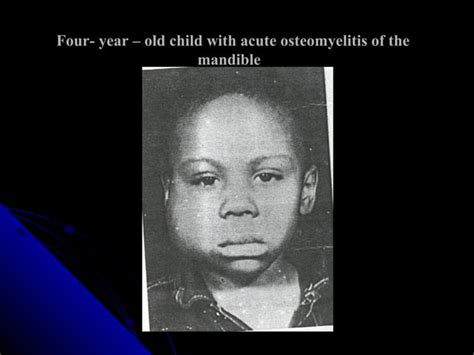 Osteomyelitis Ppt