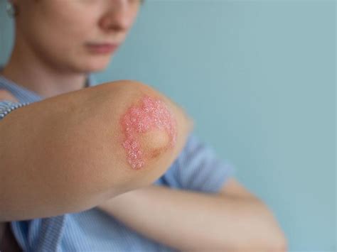 Everything About Psoriasis And Treatment Methods Remotederm