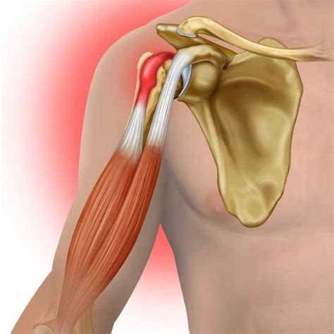 Arthroscopic Or Open Biceps Tenodesis Shoulder Surgeon South