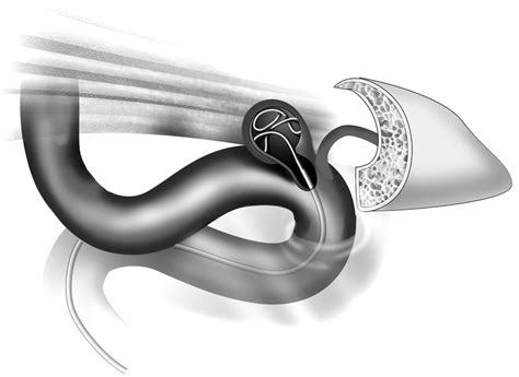 Endovascular Coil Embolization Of An Ophthalmic Segment Aneurysm Download Scientific Diagram