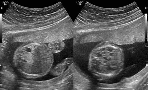 Congenital Pulmonary Airway Malformation Wikiwand