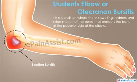 Elbow Bursitis Symptoms Bursitis Fact Sheets Yale Medicine Necnav