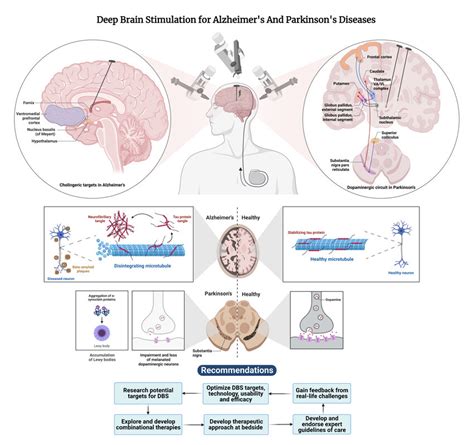 Graphical Abstract Deep Brain Stimulation For Alzheimers And