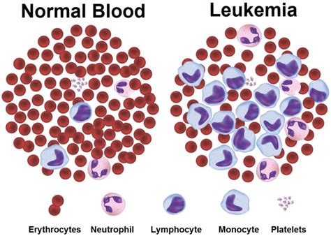 BLOOD CANCER DETECTION USING CNN AI PROJECTS