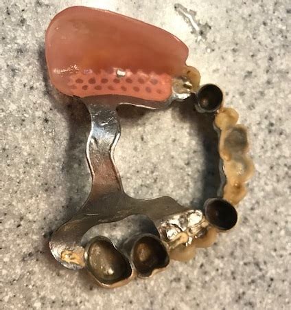 Telescopic Attachment Retained Prosthesis Bauer Smiles