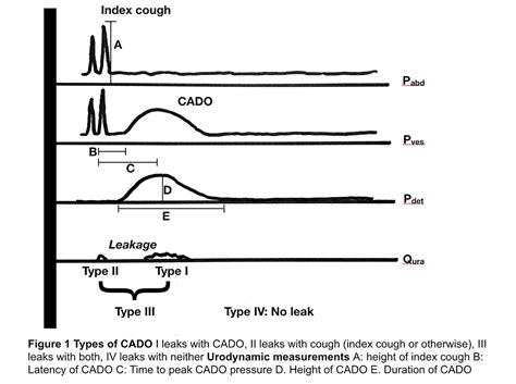 Ics 2018 Abstract 481 Cough Associated Detrusor Overactivity In Women With Urinary Incontinence
