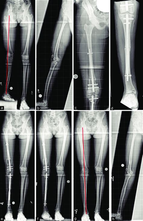 Fibular Hemimelia Diagram