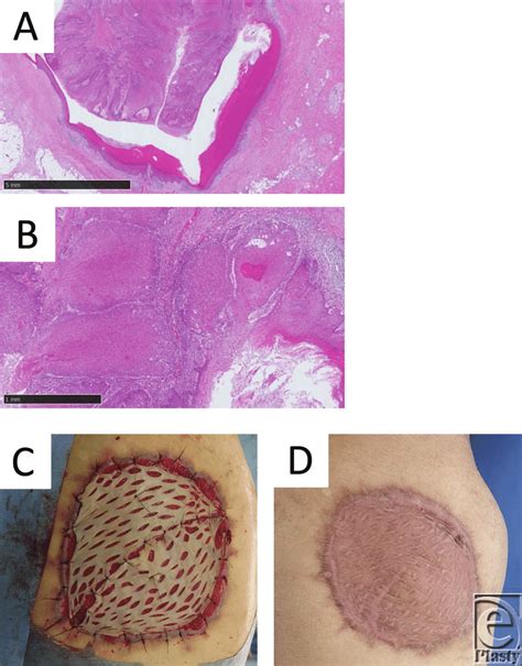 A Epithelial Findings The Epithelium Of The Squamous Cell Carcinoma