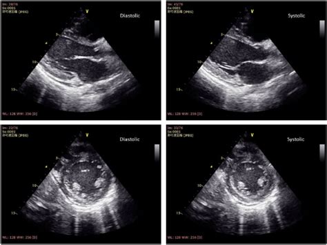 Systolic Function On Echocardiogram A Echocardiogram During The