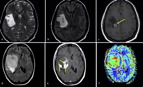 Presurgical Diagnosis Of Diffuse Gliomas In Adults Post Who 2021 Practical Perspectives From