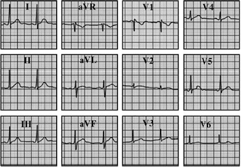 Crista Supraventricularis