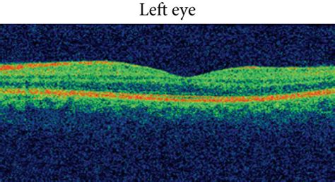 A L Serial Oct Scans Showing The Evolution Of Maculopathy Obtained