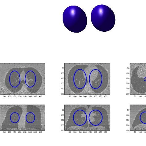 splitting of a surface during 3d image segmentation using a level set
