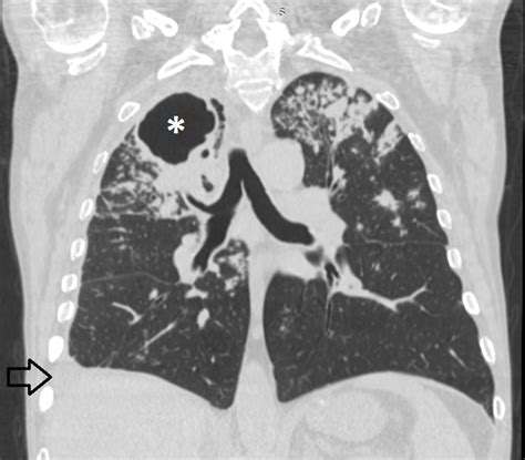 Ct Demonstrates Confluent Bronchocentric Nodules In All Segments With A Download Scientific
