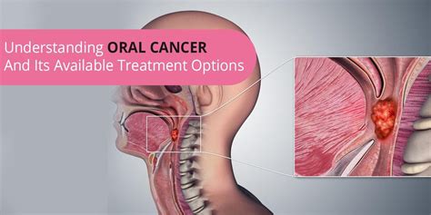 Understanding Oral Cancer And Its Available Treatment Options Dr