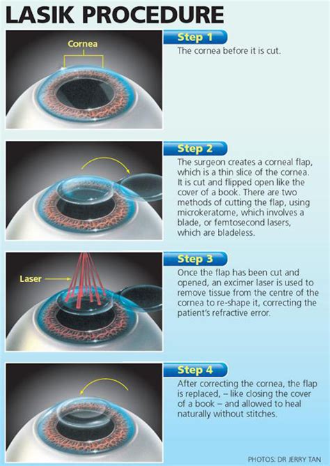 Top 10 Things You Need To Know About Lasik Eye Surgery Laser Eye
