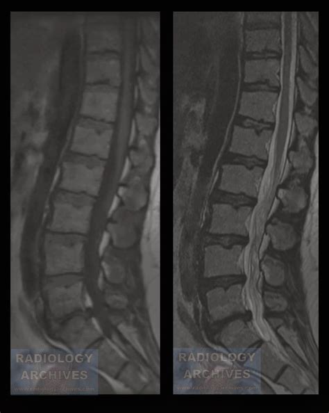 Radiology Archives Όζοι κήλες του Schmorl