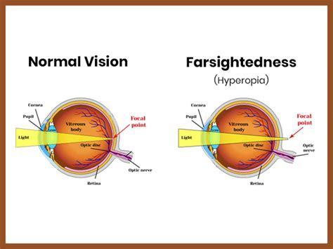 Farsightedness Hyperopia Causes Symptoms Diagnosis And Treatment