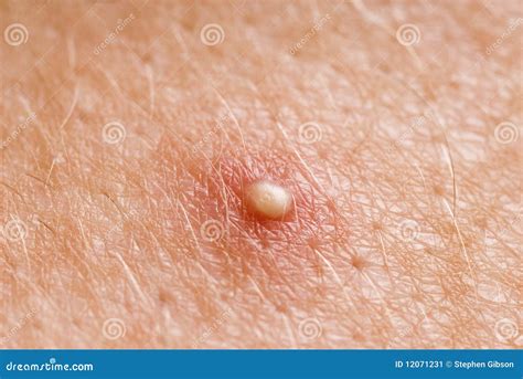 Whitehead Pimple