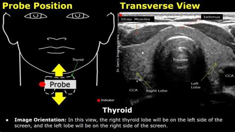 Thyroid Ultrasound Probe Positioning Transducer Placement Scanning Technique Usg Walaa Musaryi