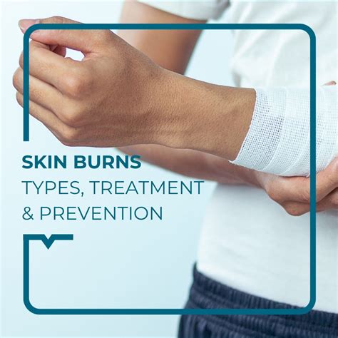 Thermal Burns Type Treatment And Prevention Alegria Medical Centre