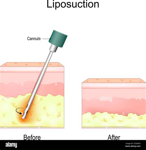 Liposuction Hips Before After