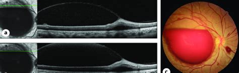 Macula SD OCT At Presentation A B And Fundus Photography At Download Scientific Diagram