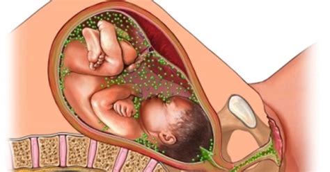 Corioamnionitis Infección En La Placenta ¿puede Poner En Riesgo La