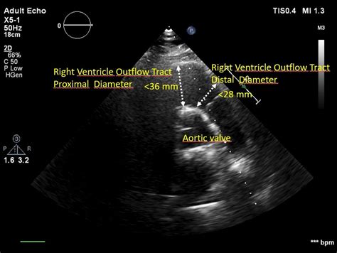 Right Ventricular Dimensions Echo At Joan Farley Blog
