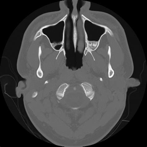 Normal Temporal Bone Ct With Annotated Images Radiopaedia 84293 99584 Axial Non Contrast Nc