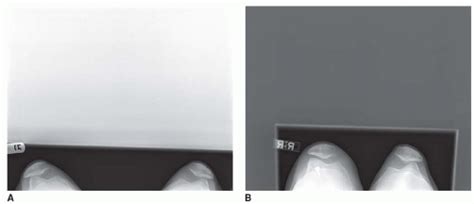 Tibial Tubercle Transfer Musculoskeletal Key