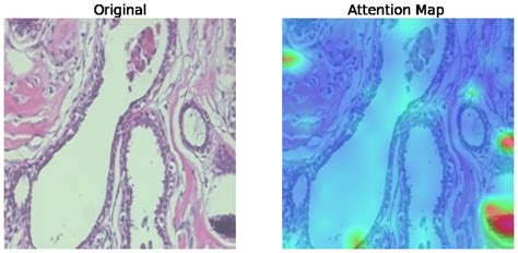 Attention Map Of The Vit Model On Sample Image From The Breakhis Dataset Download Scientific