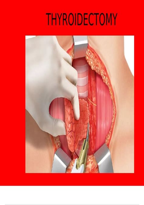 Summary Surgical Nursing Thyroidectomy Nursing Stuvia Us