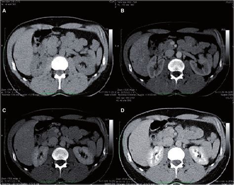 Triphasic Computed Tomography Scan Showing No Focal Liver Lesion Basal